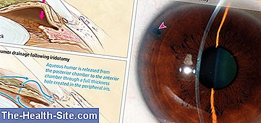 Iridectomy: ทุกอย่างสำคัญต่อการผ่าตัดตา 💊 วิทยาศาสตร์การปฏิบัติวารสาร ...