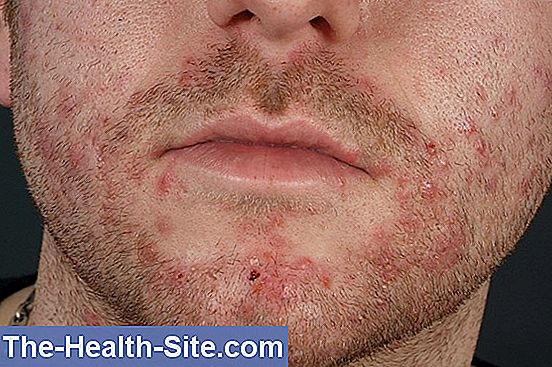 Psorijaza: Oblici, Simptomi I Uzroci 💊 Znanstveno-Praktični Medical ...