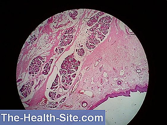 Karsinoma Sel Skuamosa (Spinalioma): Penyebab, Peluang Pemulihan 💊 ...