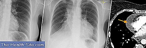 Mediasten: Fonksiyon, Anatomi, Hastalıklar 💊 Bilimsel-Pratik Tıp ...